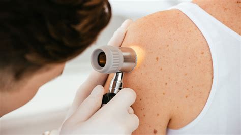 ¿lunar O Melanoma La Regla Del Abcde Te Ayuda A Diferenciarlo