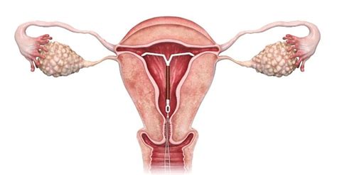 Supporting Access To Intrauterine Contraception Nursing In Practice