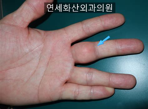 연세화산외과 손가락에 생긴 덩어리 때문에 물건 들때 불편해요 손가락의 지방종 제거 수술 서울 송파구 외과 화상