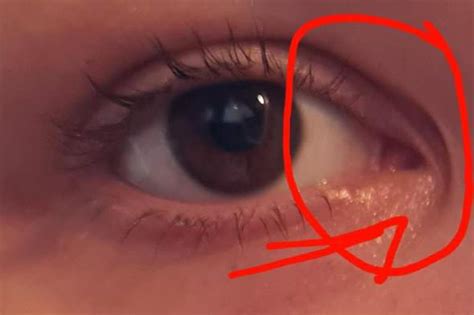 Wieso Haben Manche Menschen Diese Innere Augenfalte Gesicht Augenfalten
