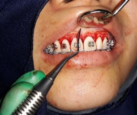 Gingival Margin Contouring With Kirkland Knife Download Scientific Diagram