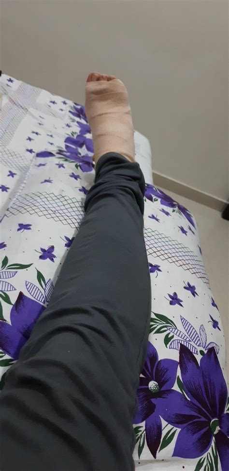 Pin By Dhafin Faza On Simpan Cepat In 2024 Broke Leg Snapchat Leg
