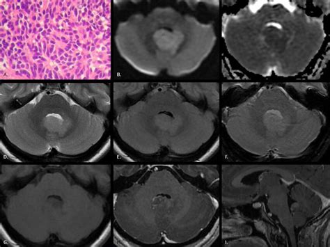 Large Cell Anaplastic And Group 3 4 Medulloblastoma In 20 Years Old