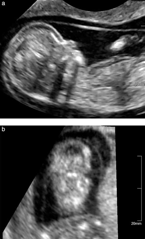 Cleft Lip 15 Week Ultrasound