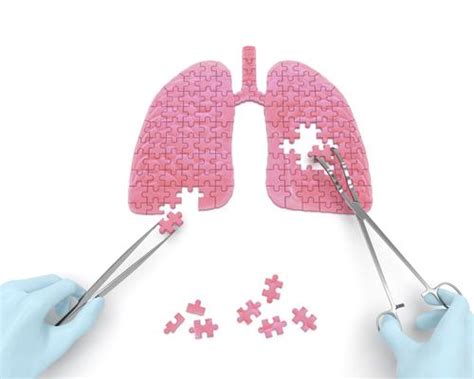 Lung Surgery Procedures Pintas And Mullins