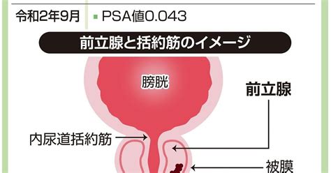 【がん相談から】前立腺全摘出後、放射線治療を提示された（1 2ページ） 産経ニュース