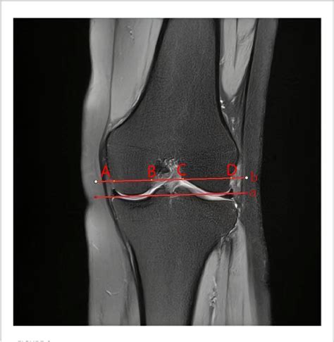 Figure 1 From Increased Lateral Femoral Condyle Ratio Measured By Mri