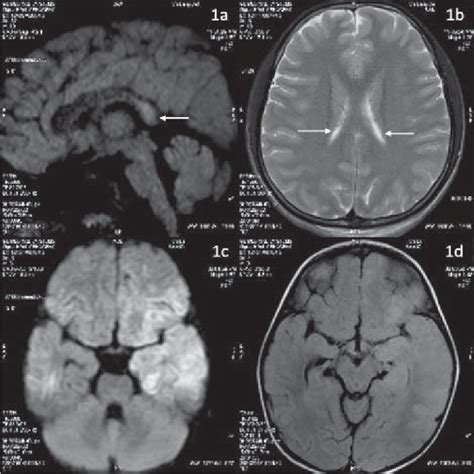 Mri Scan Brain Showing Restricted Diffusion In Splenium Of Corpus Download Scientific Diagram
