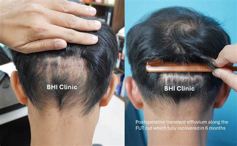 4467 Fugs Hair Transplantation Using Futstrip Excision Method Dr