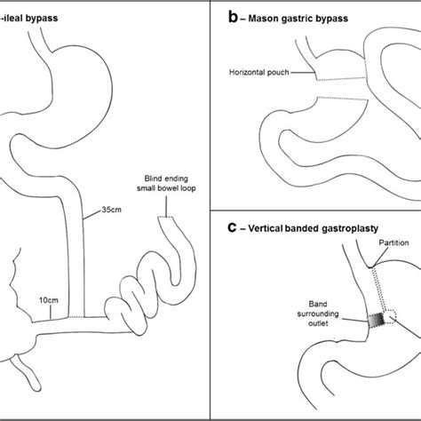 Schematic Representation Of The Single Anastomosis Duodeno Ileal Bypass