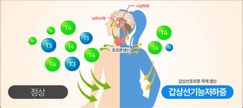 저하증하시모토갑상선염 어떤 치료가 필요할까 네이버 블로그