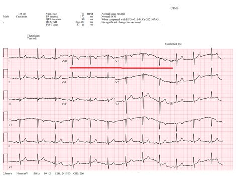 Are These The Pvcs R Pvcs