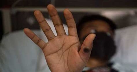 Nigeria Records 8 New Mpox Cases In A Week Outbreak Spreads To 35 Lgas