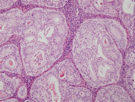 Endometrial Hyperplasia And Neoplasia Definition Diagnosis And