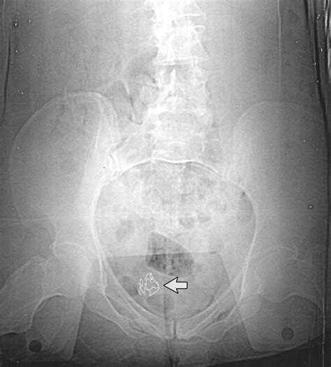 Surgical Sponge X Ray At Brayden Ologhlin Blog