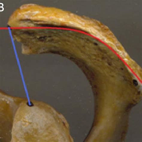 Types Of Acromion A Type I B Type Ii And C Type Iii Download