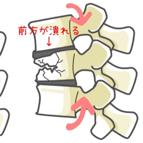 腰が曲がるから痛い訳で無い ガラッパチ院長トミー伊丹市の鍼灸接骨院地獄を見た漢の華麗なる復活ブログ