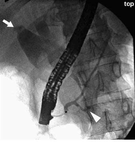 Figure 1 From A Rare Choledochal Cyst Of The Cystic Duct With An
