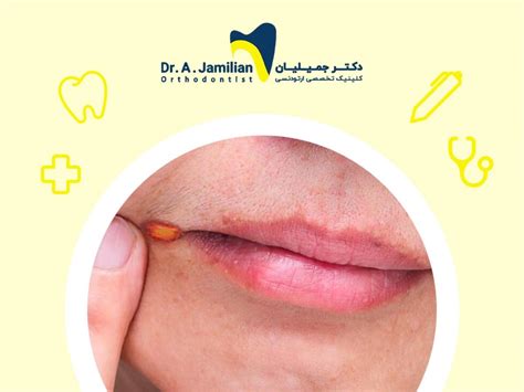 Angular Cheilitis Causes And Treatments Dr Jamilian