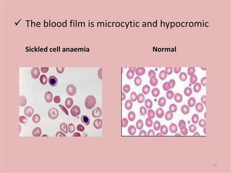 Diagnosis Sickle Cell Anemia Pptx