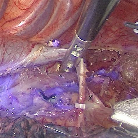 Icg Nir Image Guided Identification Of Esophageal Lymph Nodes A Icg