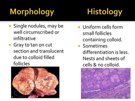 Neoplasms Of Thyroid Gland Pptx Thyroid Disorders Endocrine And Metabolic Diseases