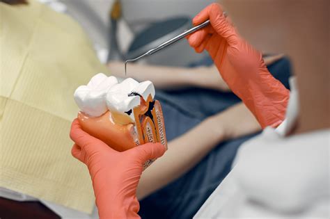 A Root Canal Procedure Explained
