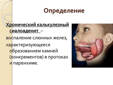 Диагностика лечение хронического калькулезного сиалоаденита