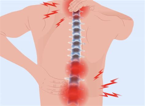 허리염증 원인 단순 통증 뿐만 아니라 급성 근육 염좌 혹은 염증성 자가면역 기전 질환 관련있다면 네이트뷰