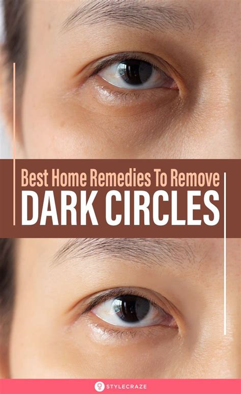 13 Natural Ways To Treat Dark Circles Under The Eyes At Home Artofit
