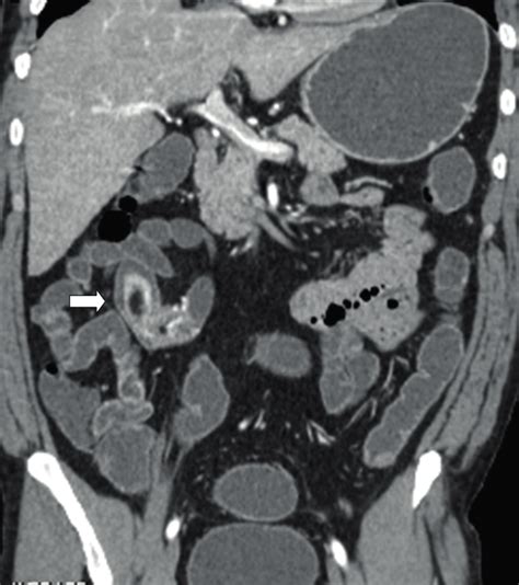 61 Year Old Man Ct Enterography With Peg Shows An Intraluminal Mass