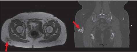 Heterotopic Ossification Radiological And Pathological Review Pmc