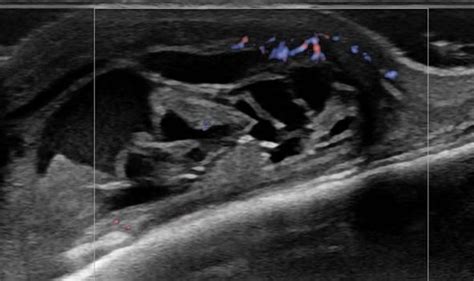 Musculoskeletal Joints And Tendons 6 2 Elbow Case 6 2 5 Olecranon
