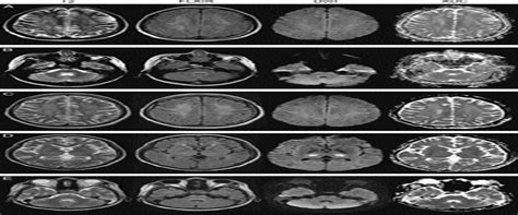 Severe Fatal Methotrexate Related Neurotoxicity In 2 Adoles Journal Of Pediatric
