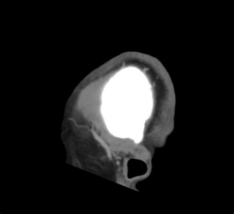 Cerebral Venous Infarction Due To Transverse Sinus Thrombosis