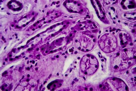 Diffuse Proliferative Glomerulonephritis Stock Image Image Of Pathology Glomerulonephritis