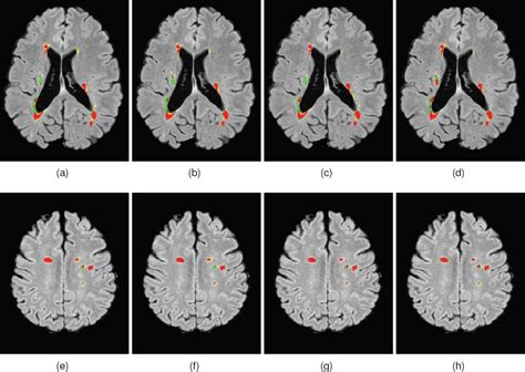 Edges Enhanced Convolutional Neural Network For Multiple Sclerosis Lesions Segmentation