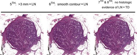 Lymph Node Metastasis In Colorectal Cancer Surgical Oncology Clinics
