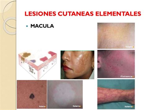 Lesiones Cutaneas Elementales Dermatologia Efrain Negrete