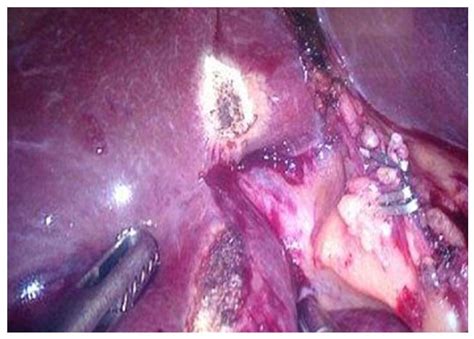 Laparoscopic Hepatectomy For Benign Hepatic Lesions Short And Long