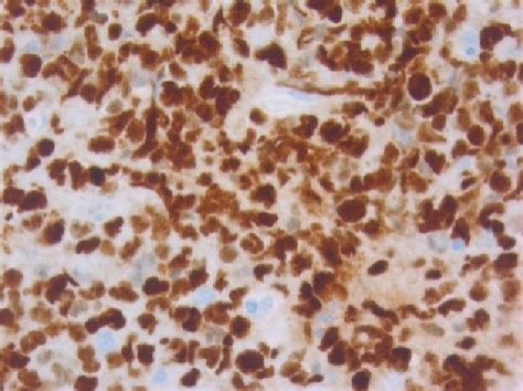 Primary CNS Lymphoma Arising From The 4th Ventricle A Diffuse Sheets Download Scientific