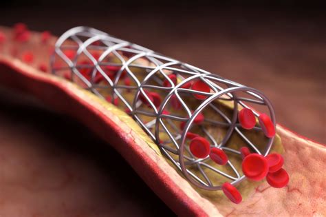 Long Term Outcomes After Pci With New Generation Des For P Lad Vs Non P