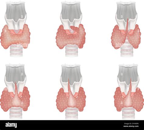 Pyramidal Lobe Variations In Thyroid Anatomy And Pyramidal Lobe Classification Of The Thyroid