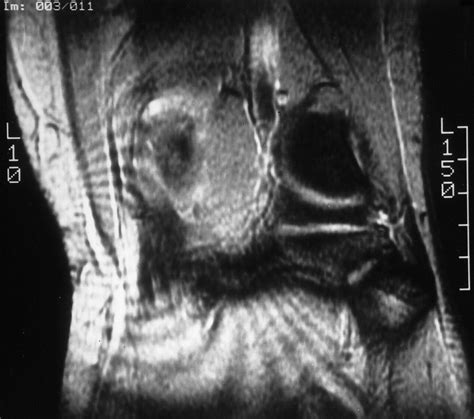 Signal Intensity Artifacts In Clinical Mr Imaging Radiographics