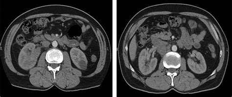 The Ct Scan Shows A Suspicious Looking Ill Defined Infiltrating Right