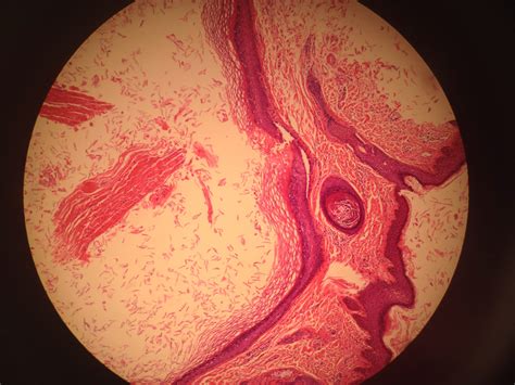 Any Advice On Possible Acantholytic Feature In Epidermal Inclusion Cyst Researchgate