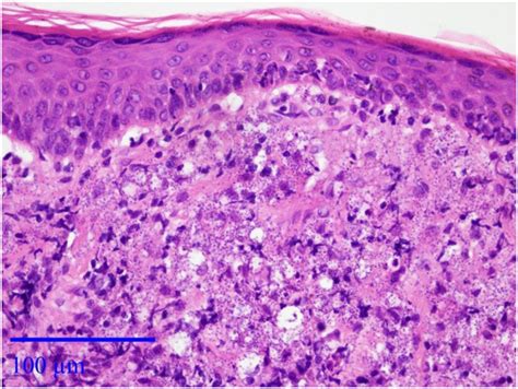Histological Section Mucocutaneous Lesion There Is Moderate Epidermal