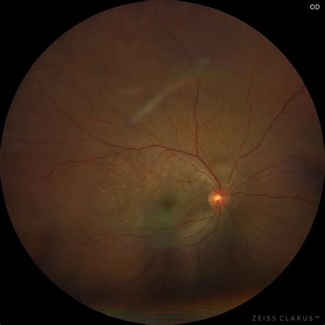 Non Infectious Choroiditis Archivos Retina Club Retina Club