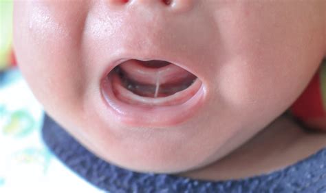 Sublingual Gland Swelling