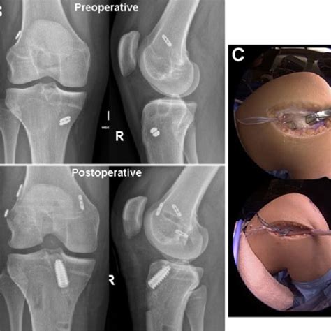 A Illustration Of Lateral Extra Articular Tenodesis Using The